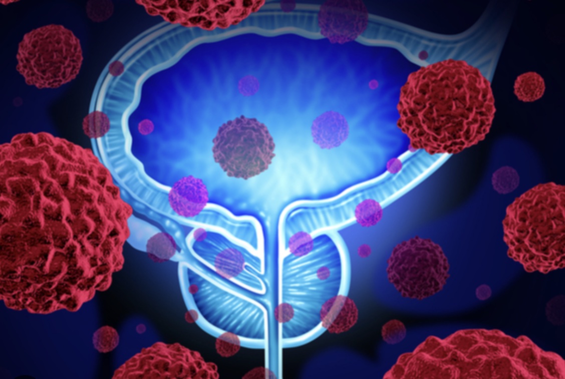 Precision Prostate Cancer Diagnostic Testing – Main