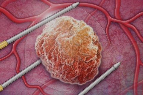 Atrium Surgical Center | Prostate Program